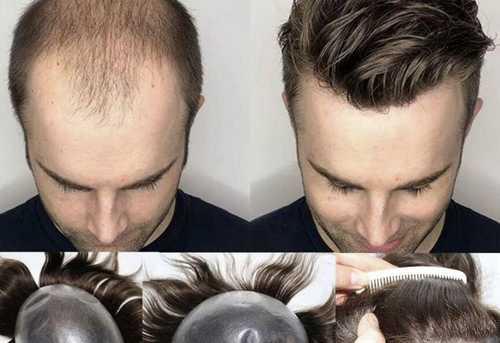 Система замещения волос для мужчин