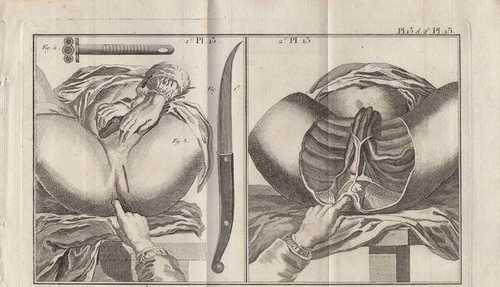 Гравюры. Хирургия. Операция. Медицина. 1780 г. Ч1