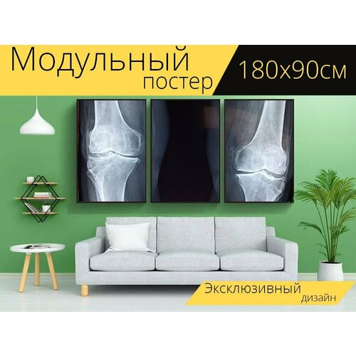 Модульный постер "Колено, рентгеновские, медицинский" 180 x 90 см. для интерьера