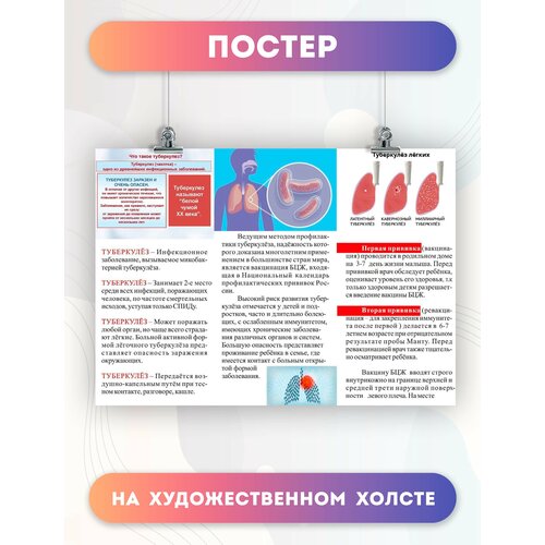 Постер на холсте туберкулез больницы медицина (35) 50х70 см